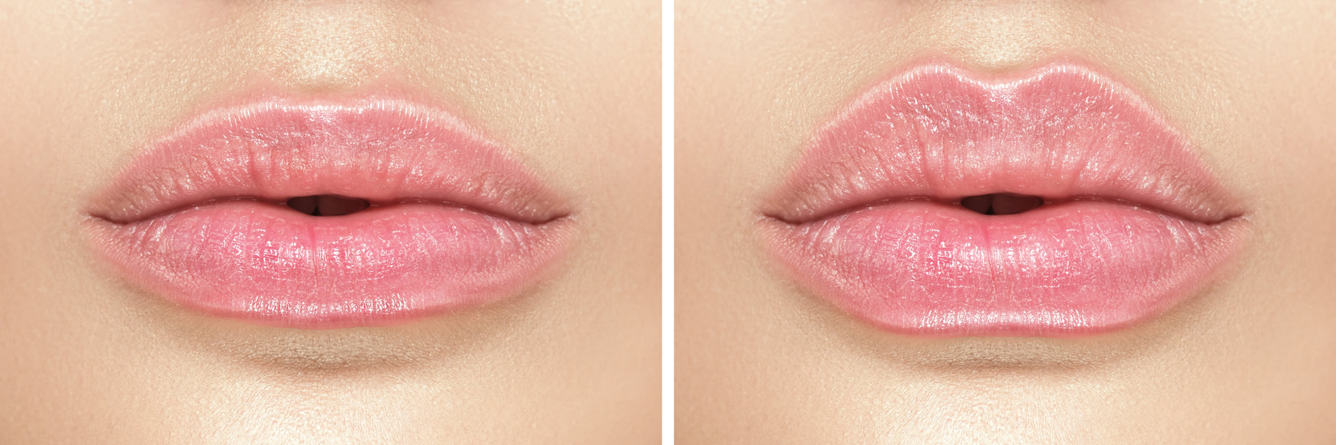 West Hollywood Juvederm Injections | Los Angeles Juvederm Dermal Filler ...