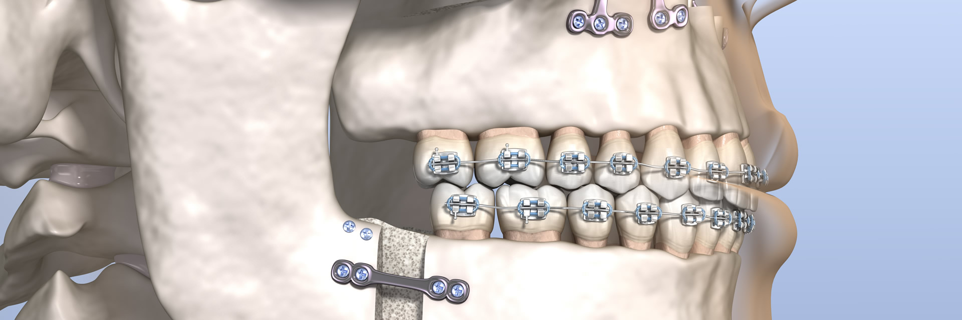 West Hollywood Orthognathic/Corrective Jaw Surgery | Los Angeles ...